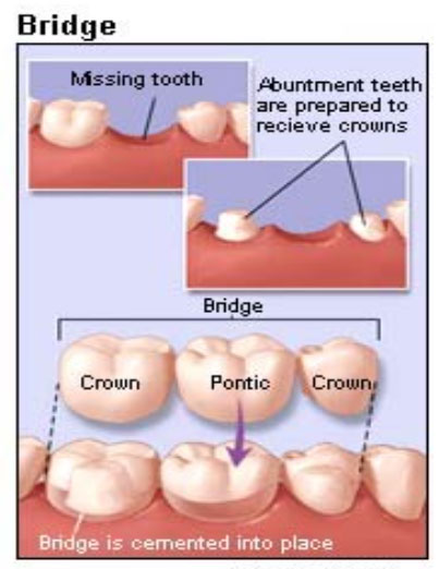 Bridges - Barnehurst Dentist